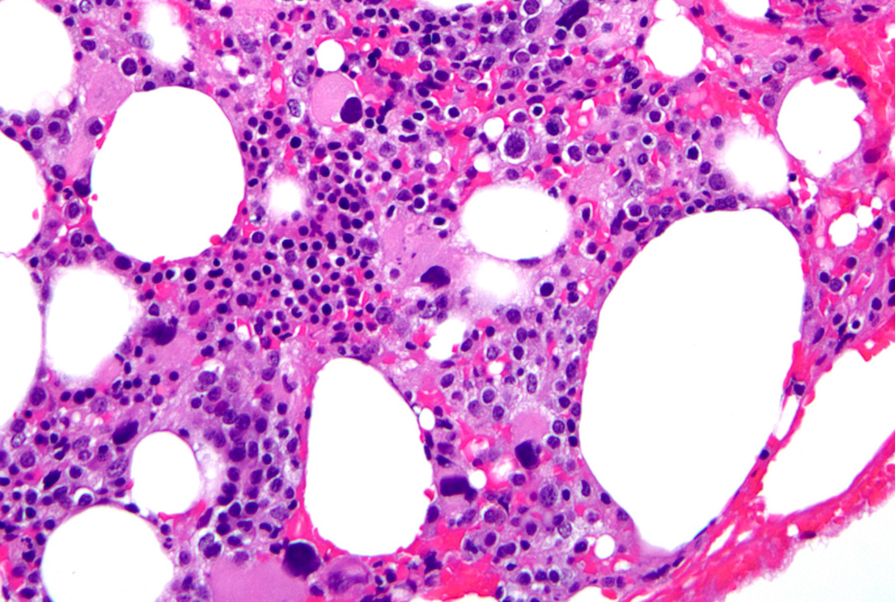 Megaloblastic Anemia & MDS – Vancouver IM LMR