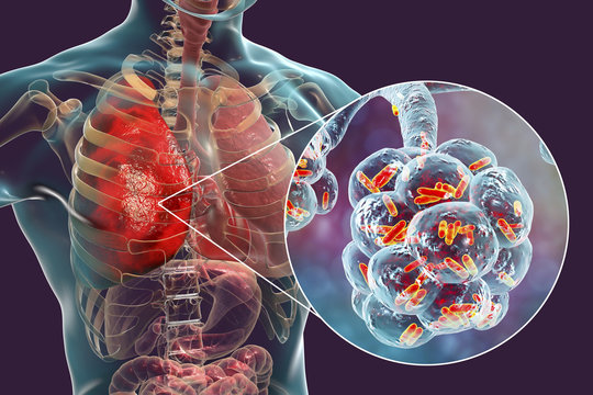 A curious case of PJP pneumonia – Vancouver IM LMR